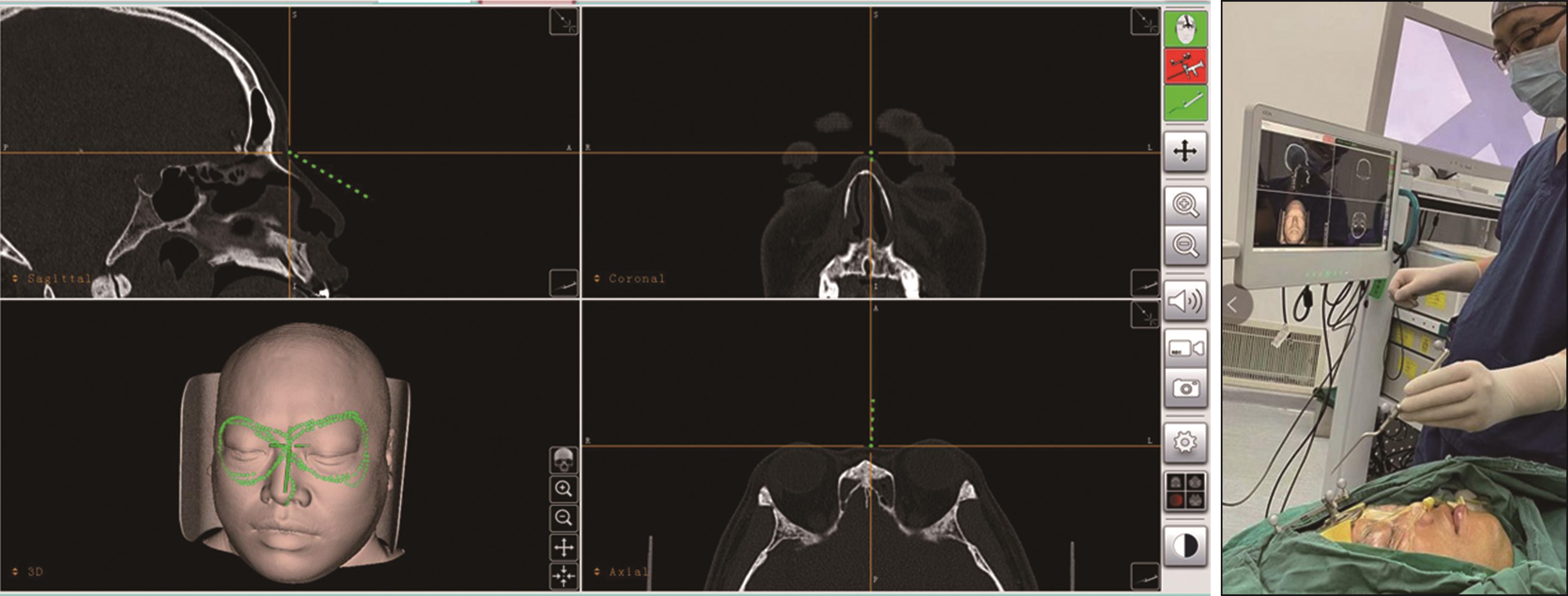 Preliminary study on the resection of parapharyngeal and lateral skull ...
